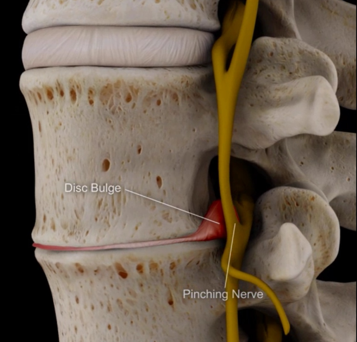 Disc Injury Treatment | Back Basics